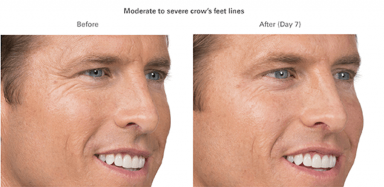 Seattle Botox Services | Blue Haven Medical Spa Green Lake