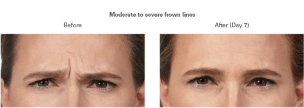 Seattle Botox Services | Blue Haven Medical Spa Green Lake