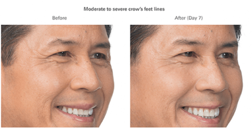 Seattle Botox Services | Blue Haven Medical Spa Green Lake