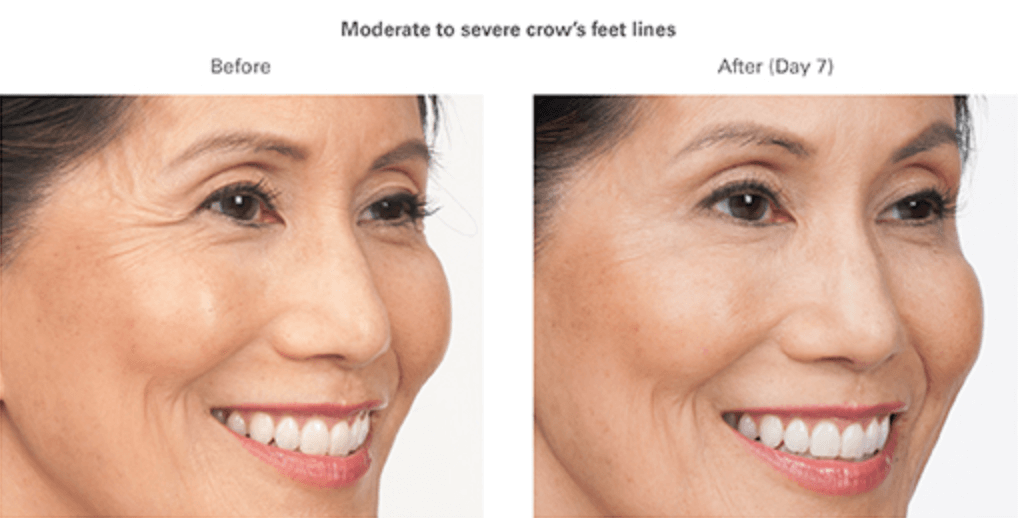 Seattle Botox Services | Blue Haven Medical Spa Green Lake