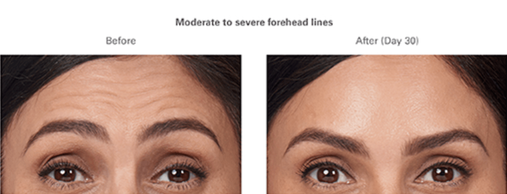 Seattle Botox Services | Blue Haven Medical Spa Green Lake