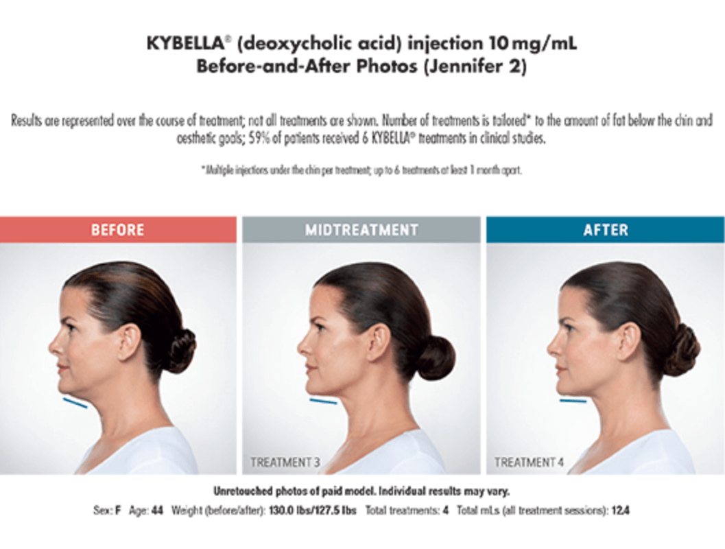 Seattle Kybella Services - Blue Haven Medical Spa Green Lake
