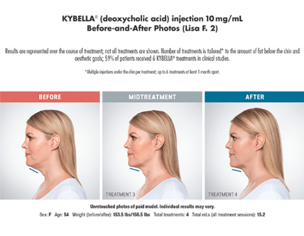 Seattle Kybella Services - Blue Haven Medical Spa Green Lake