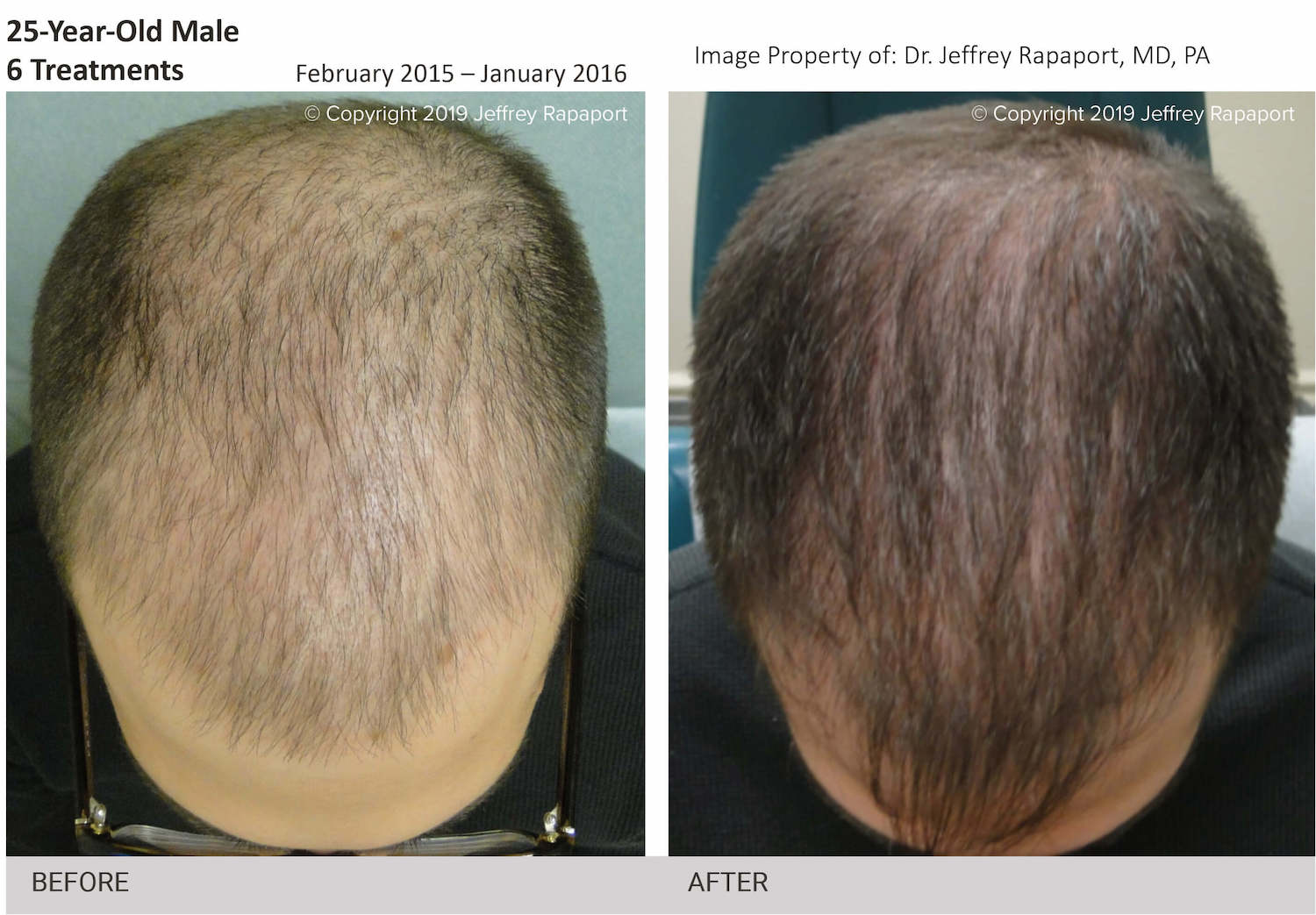 Seattle PRP Hair Restoration Services - Blue Haven Medical Spa Green Lake