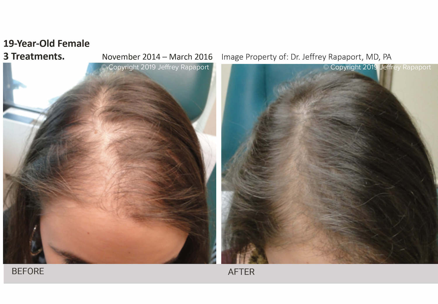 Seattle PRP Hair Restoration Services - Blue Haven Medical Spa Green Lake