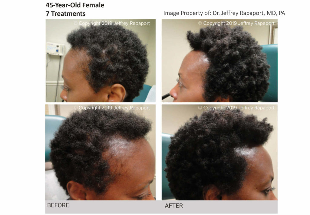 Seattle PRP Hair Restoration Services - Blue Haven Medical Spa Green Lake