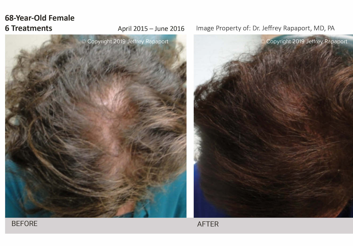 Seattle PRP Hair Restoration Services - Blue Haven Medical Spa Green Lake