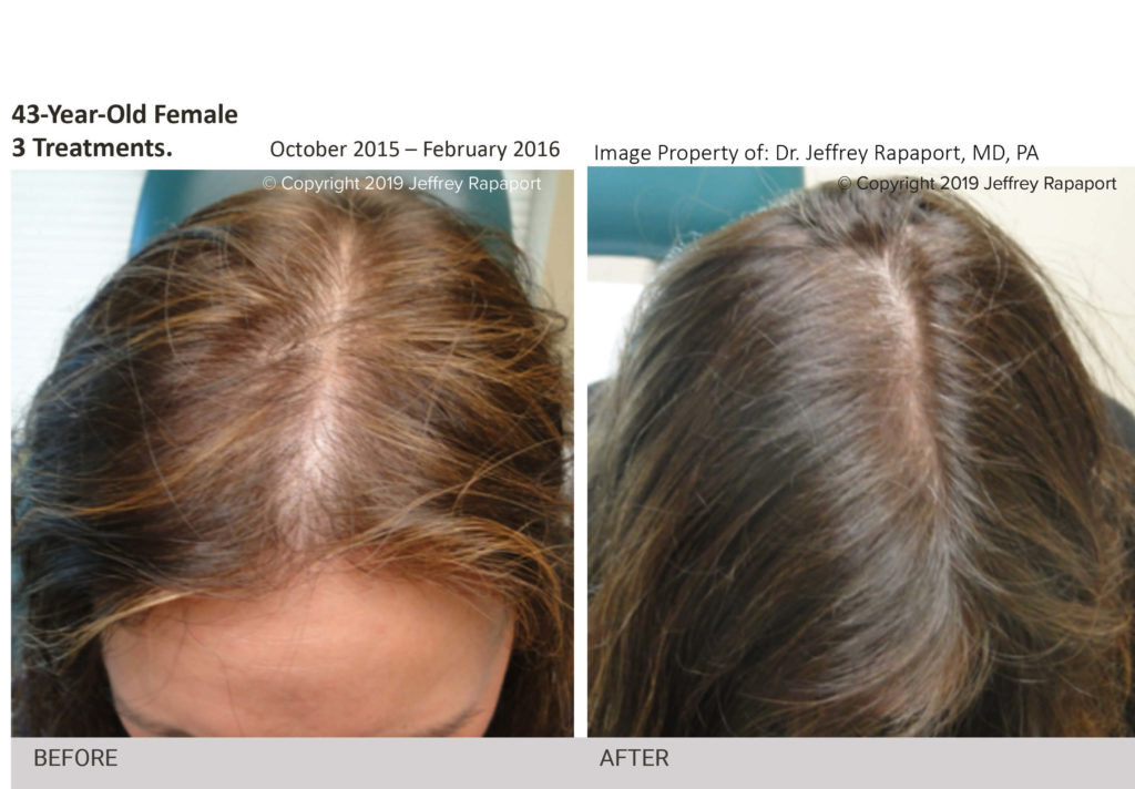 Seattle PRP Hair Restoration Services - Blue Haven Medical Spa Green Lake