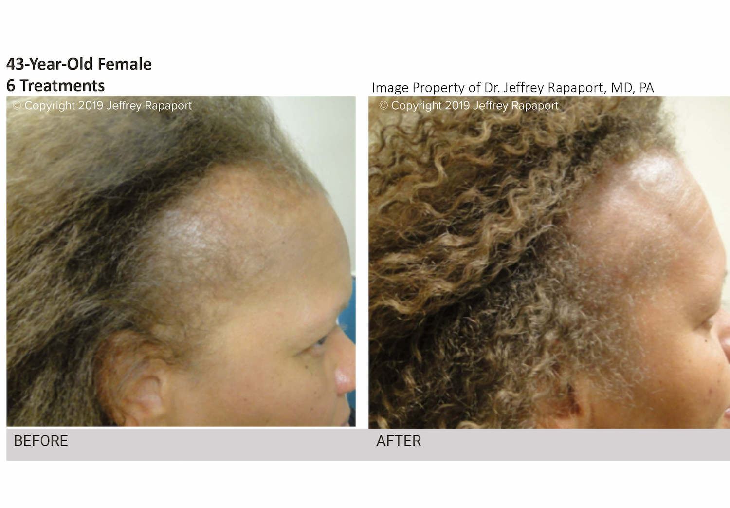 Seattle PRP Hair Restoration Services - Blue Haven Medical Spa Green Lake