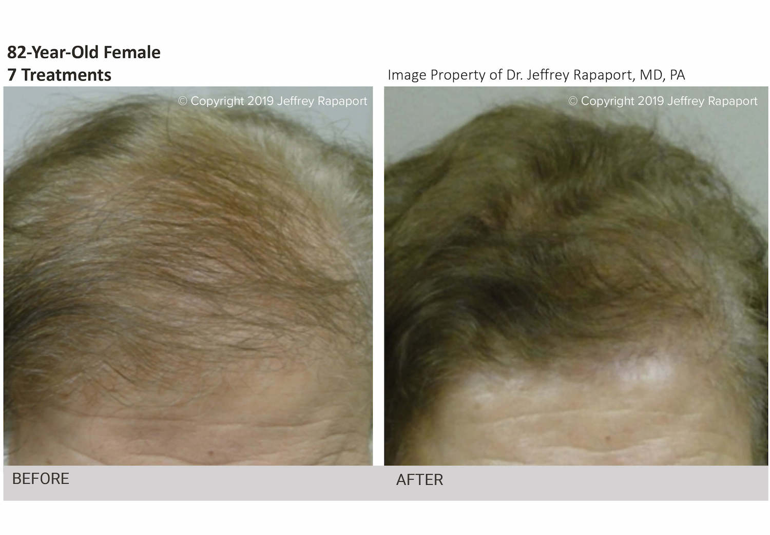 Seattle PRP Hair Restoration Services - Blue Haven Medical Spa Green Lake