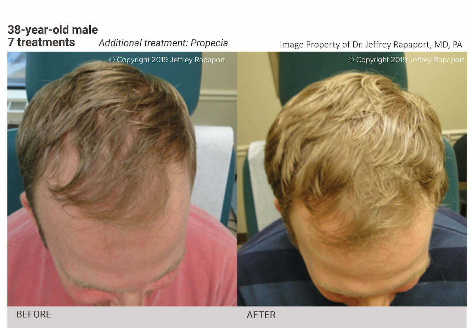 Seattle PRP Hair Restoration Services - Blue Haven Medical Spa Green Lake