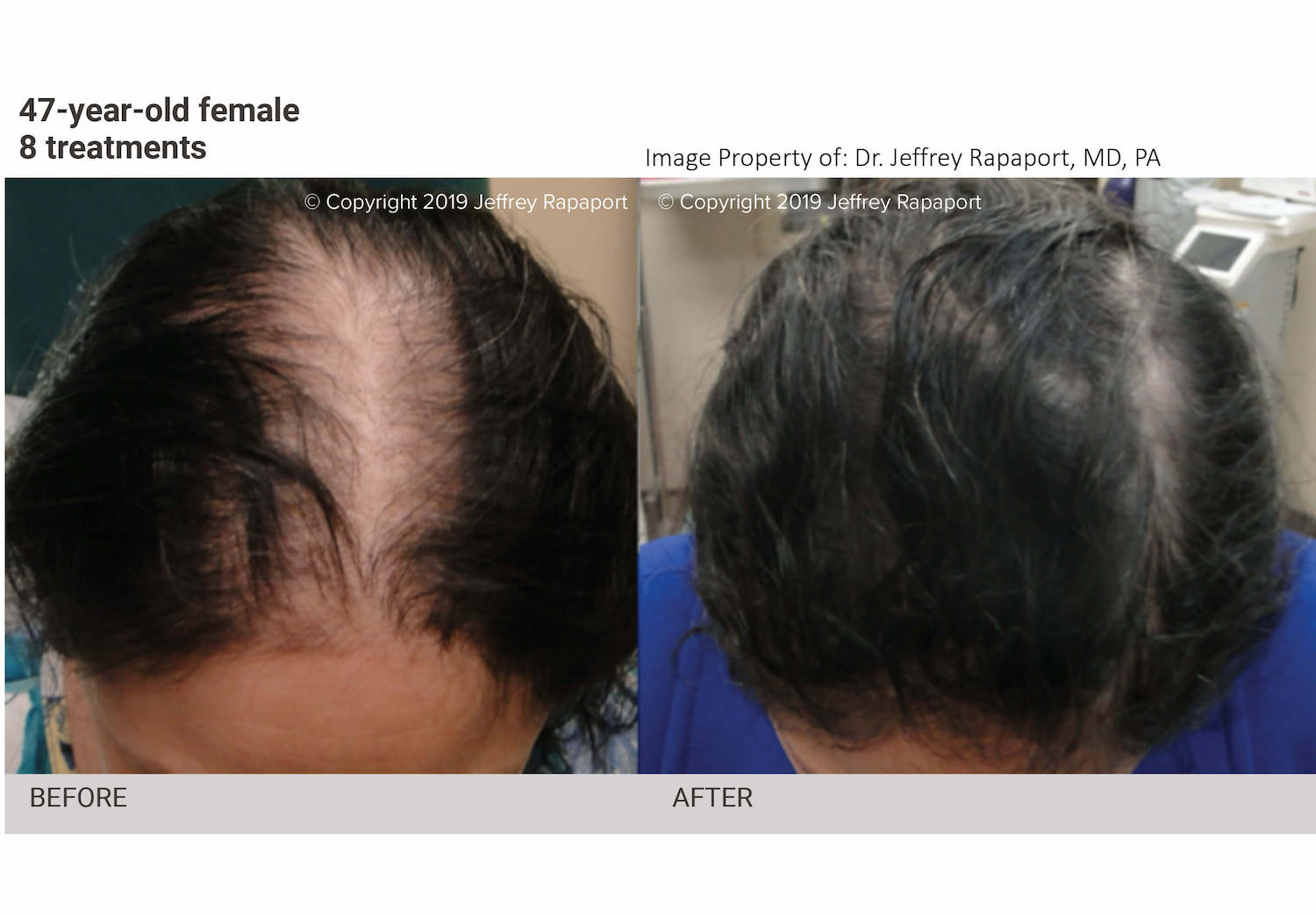 Seattle PRP Hair Restoration Services - Blue Haven Medical Spa Green Lake